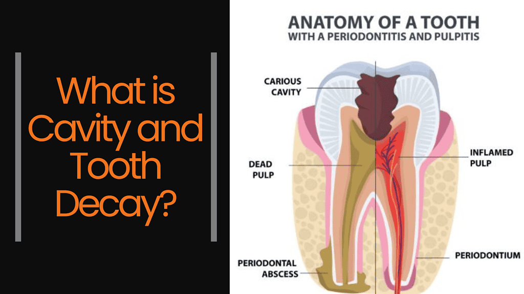 Tooth Cavities and Cavities Treatment in Shillong | Floss Dental Clinic